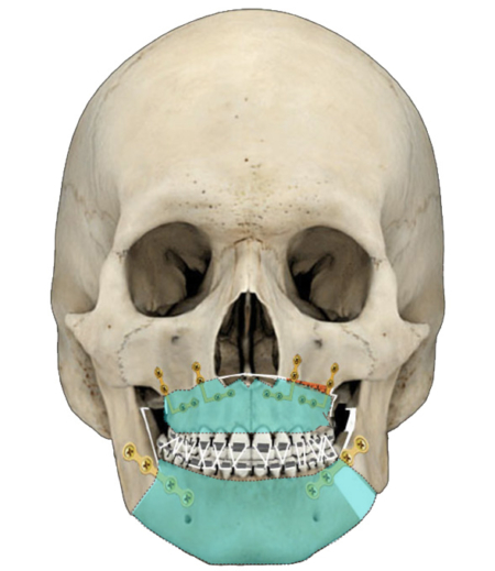 LA CHIRURGIE BI-MAXILLAIRE est une opération de la mâchoire